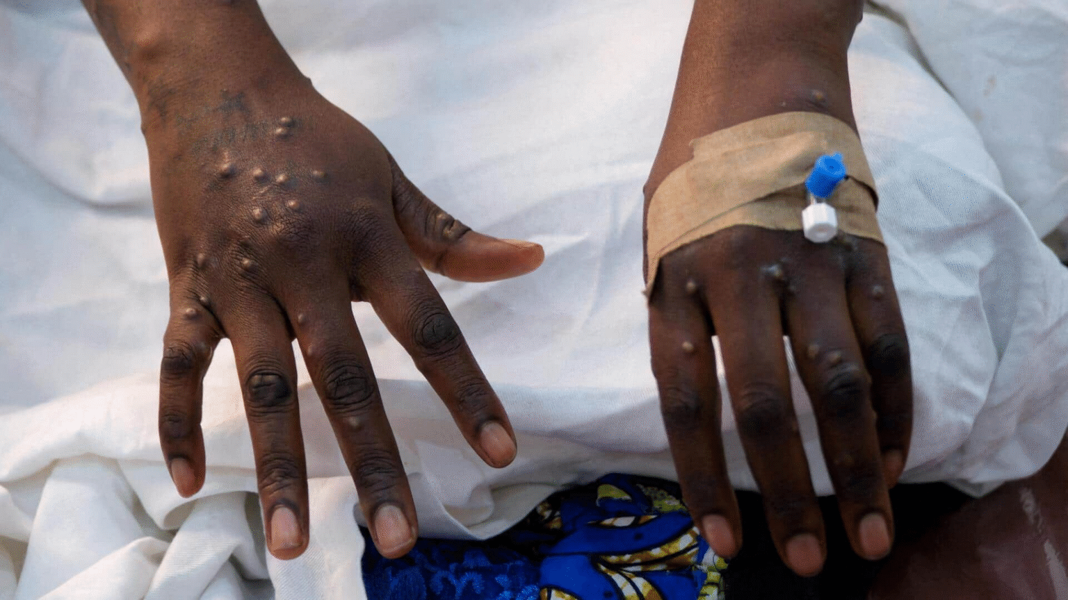Ethiopia Confirms First Marburg Outbreak, as Fear and Vigilance escalate in Jinka – eandelmagazine